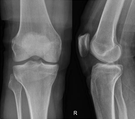 Figure 2 From Proximal Tibiofibular Joint Ganglion Cy