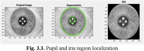 Figure 11 From Implementation Of Geodesic Active Contour Approach To Localize Anomaly Marker On