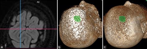 Use Of Cost Effective Software For Lesion Localization In Brain Surgery Technical Note