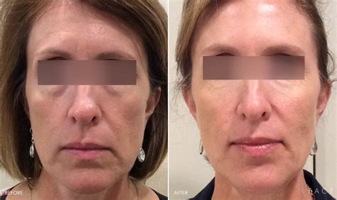 Face Photo Gallery Injectables Face Beauty Science