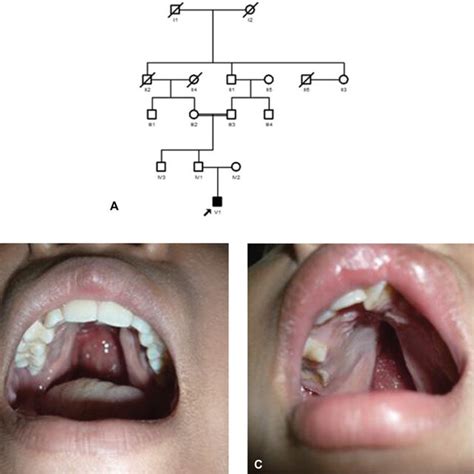 Type Of Consanguinity Of Patients With Ns Cl P Download Scientific