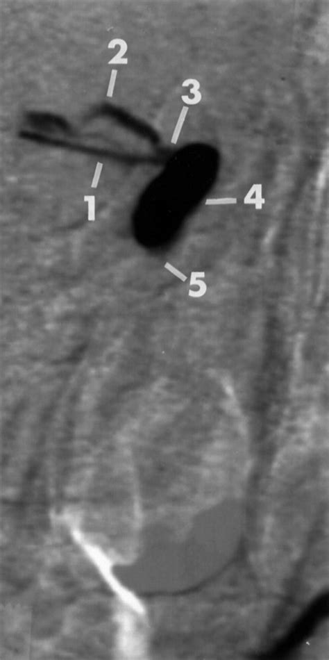 Abscess Of The Lacrimal Sac Due To Chronic Or Subacute Dacryocystitis
