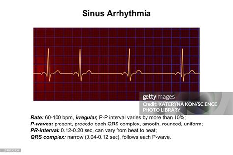 Sinus Arrhythmia Heartbeat Rhythm Illustration High Res Vector Graphic Getty Images Sinus Arrhythmia Heartbeat Rhythm Illustration High Res Vector Graphic Getty Images