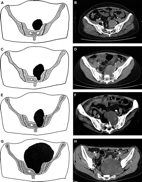 Surgical Strategy And Application Of Robotic Assisted Benign Sacral Neurogenic Tumor Resection