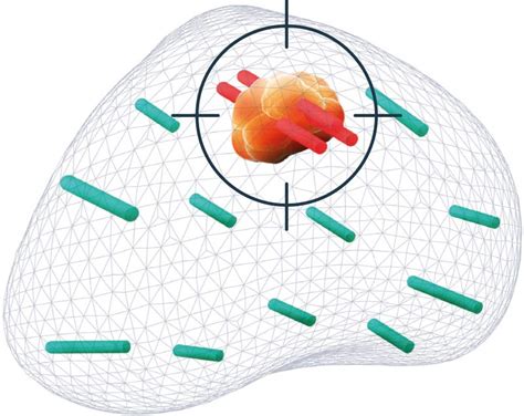 Promap Focal Therapy Koelis