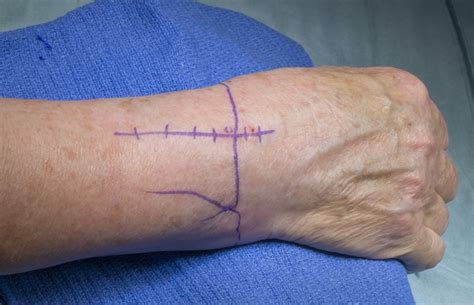 Listers Tubercle Palpation