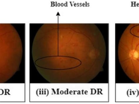 A Multidomain Bio Inspired Feature Extraction And Selection Model For Diabetic Retinopathy