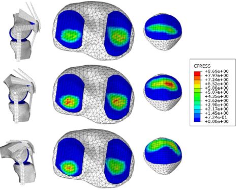 Figure From Statistical Modeling To Investigate Anatomy And Function Of The Knee Semantic