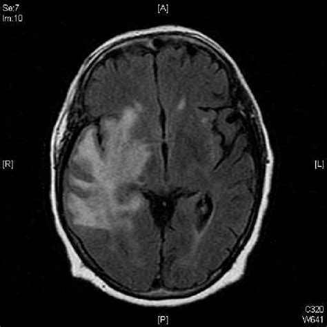 Axial Flare T 2 Weighted Mri With Water Suppression Showing Right Basal