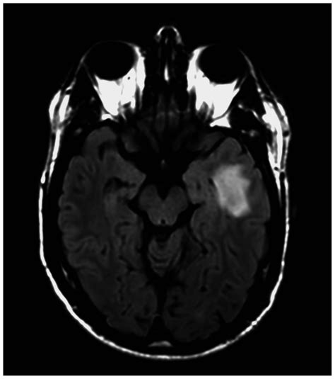 Neurosarcoidosis Pmc