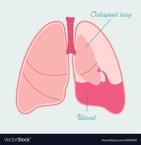 How To Identify A Collapsed Lung At Gemma Adcock Blog