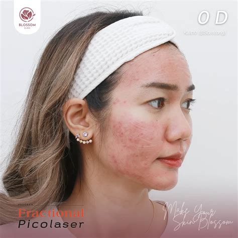 Pico Laser คออะไร ทำไมถงยอดนยม ลดกระ ฝา ท blossomclinic