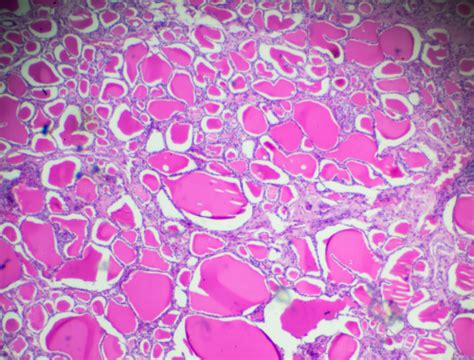 Difference Between Hypo Goiter And Hyper Goiter Difference Between