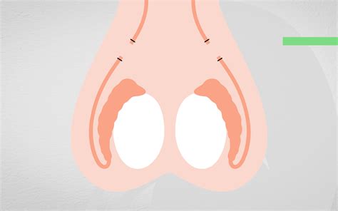 Mitos Sobre La Vasectomía ¡conócelos Dr Moisés Mendoza