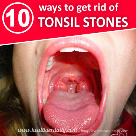 Flushing Out Tonsil Stones At Alejandra Henning Blog