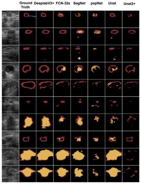 biomedicines free full text improving breast cancer detection and
