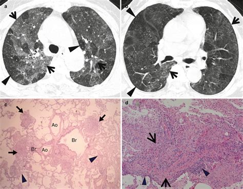 Ground Glass Opacity Without Reticulation Radiology Key