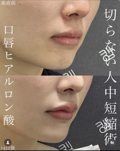 切らない人中短縮術 保存版】💎施術14日後 Emmo Face Clinic
