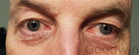 Lesson Evaluation And Diagnosis Of Pupil Disorders