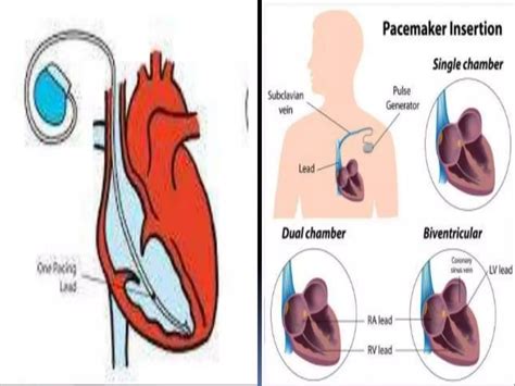 Pacemaker Powerpoint Presentation Med Surg Pptx