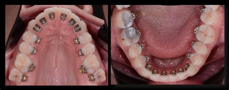 Self Ligating Lingual Brackets After Indirect Bonding Download Scientific Diagram