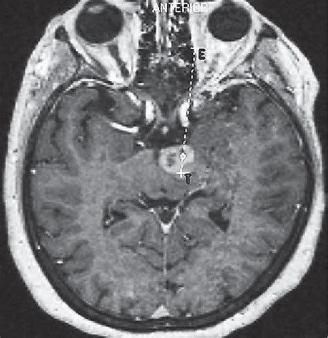 Figure 1 From Stereotactic Biopsy For Brainstem Tumors Comparison Of Transcerebellar With