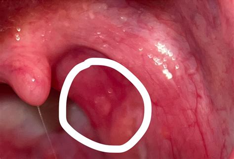 Is This A Tonsil Ulcer What Is It Warning Hd Photo Raskdoctorsmeeee