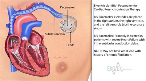 Biventricular Pacemaker
