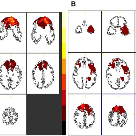 Reconstruction Of Lesions For Each Patient With Frontopolar Cortex Download Scientific Diagram