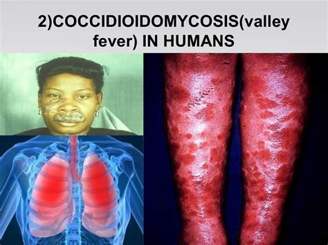 Fungal Diseases In Humans And Animals
