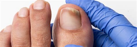 Subunguaal Hematoom Bloeduitstorting Of Blauwe Nagel Herome Cosmetics