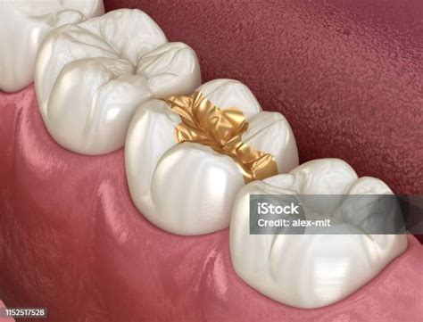 골든 인 레이 크라운이 치아 위에 고정 됩니다 인간의 치아 치료의 의학적으로 정확한 3d 그림 3차원 형태에 대한 스톡 사진 및 기타 이미지 Istock