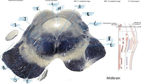 Midbrain Cross Section Flashcards Quizlet