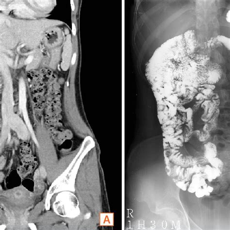 Findings Of Abdominal Ct And Small Bowel Follow Through Abdominal Ct Download Scientific