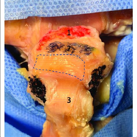 Sagittal Mri Showing The Section Represent The Center Of Olecranon