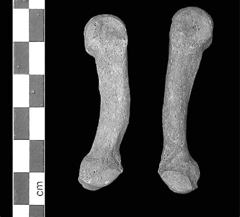 Right 5th Metacarpal On The Left In The Photo Of The Hand Showing