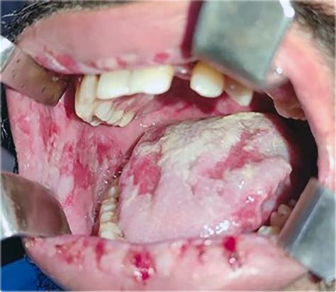 Erythema Multiforme Symptoms Complications Treatment DentaMasters