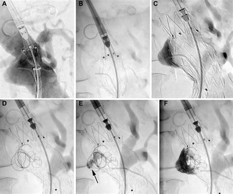 Onyx Liquid Embolic System Semantic Scholar