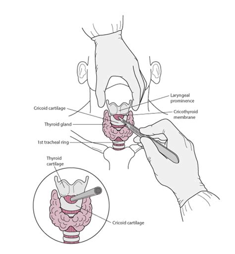 Imageemergency Cricothyrotomy Msd Manual Professional Edition