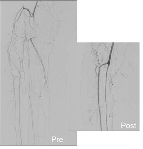 Tibial Endarterectomy In Conjunction With Popliteal Endarterectomy In Lieu Of Bypass A Surgeon