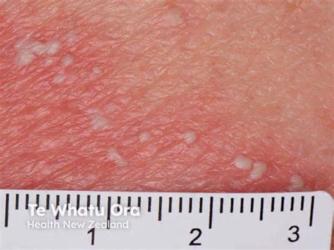 Generalised Pustular Psoriasis Images DermNet