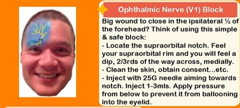 Ophthalmic Nerve Block V1