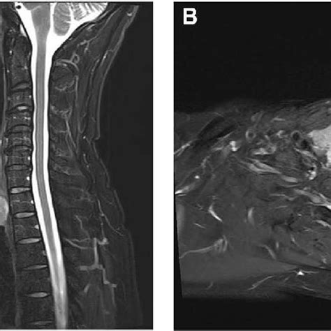 T2 Weighted Magnetic Resonance Imaging Of Upper Tracheal Tumor A Download Scientific Diagram