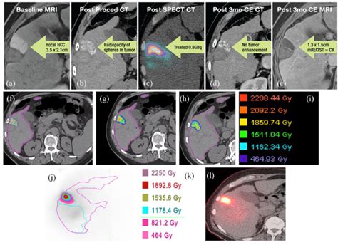 New Frontiers In Radioembolization Pmc