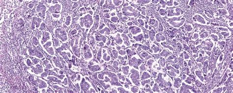 Basolateral Staining In Micropapillary Carcinoma Her2know