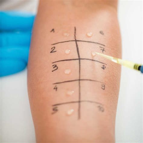 Allergy Testing Using Prick Testing In Abu Dhabi Edcc