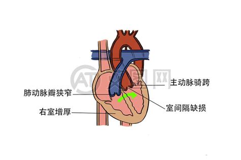 法洛四联症的四种缺陷示意图片医疗图片素材高清图片素材