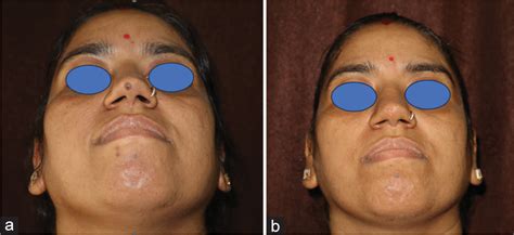 Elliptical Excision And Primary Closure Of Nasal Defect To Achieve Best Esthetic Outcome A Case