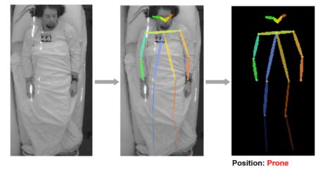 Using AI To Prevent Pressure Ulcers In Hospitals GoodAI