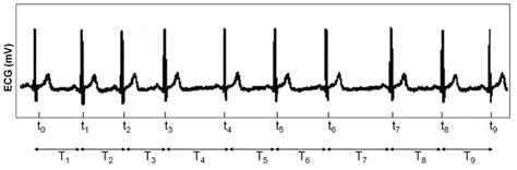 An R R Interval Time Series Example Download Scientific Diagram